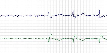 Beecardia - Physiobank - MIT-BIH Arrhythmia - Record 232